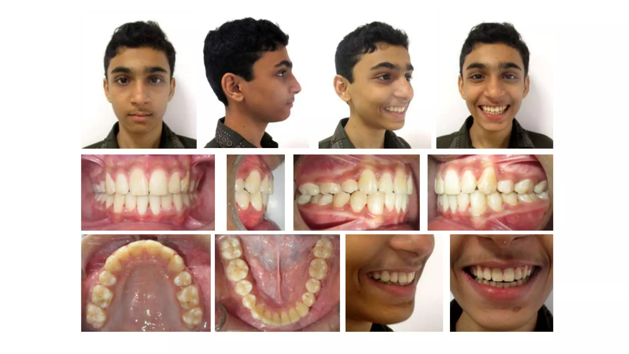management of class ii and iii malocclusion | PPTX