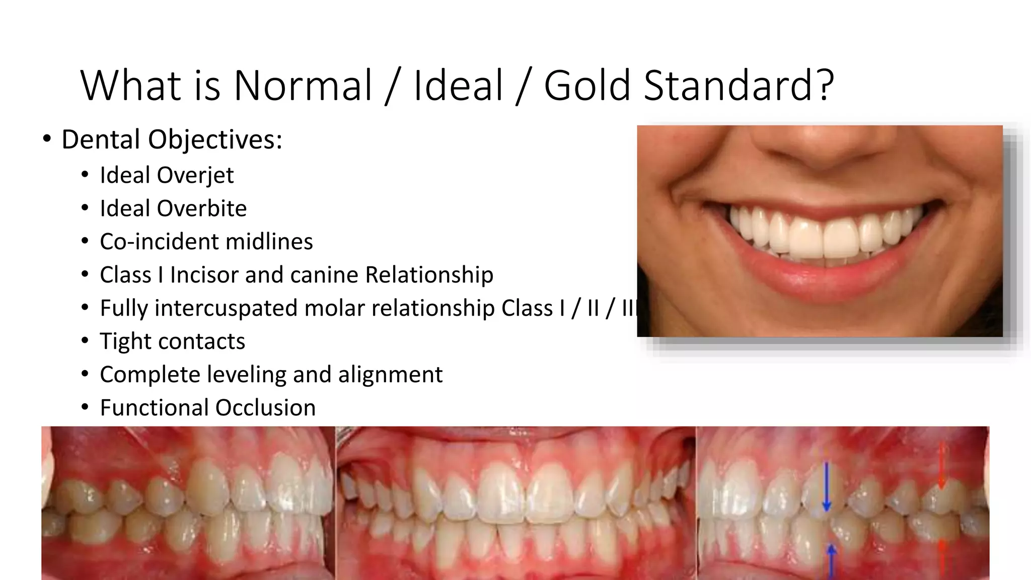 management of class ii and iii malocclusion | PPTX