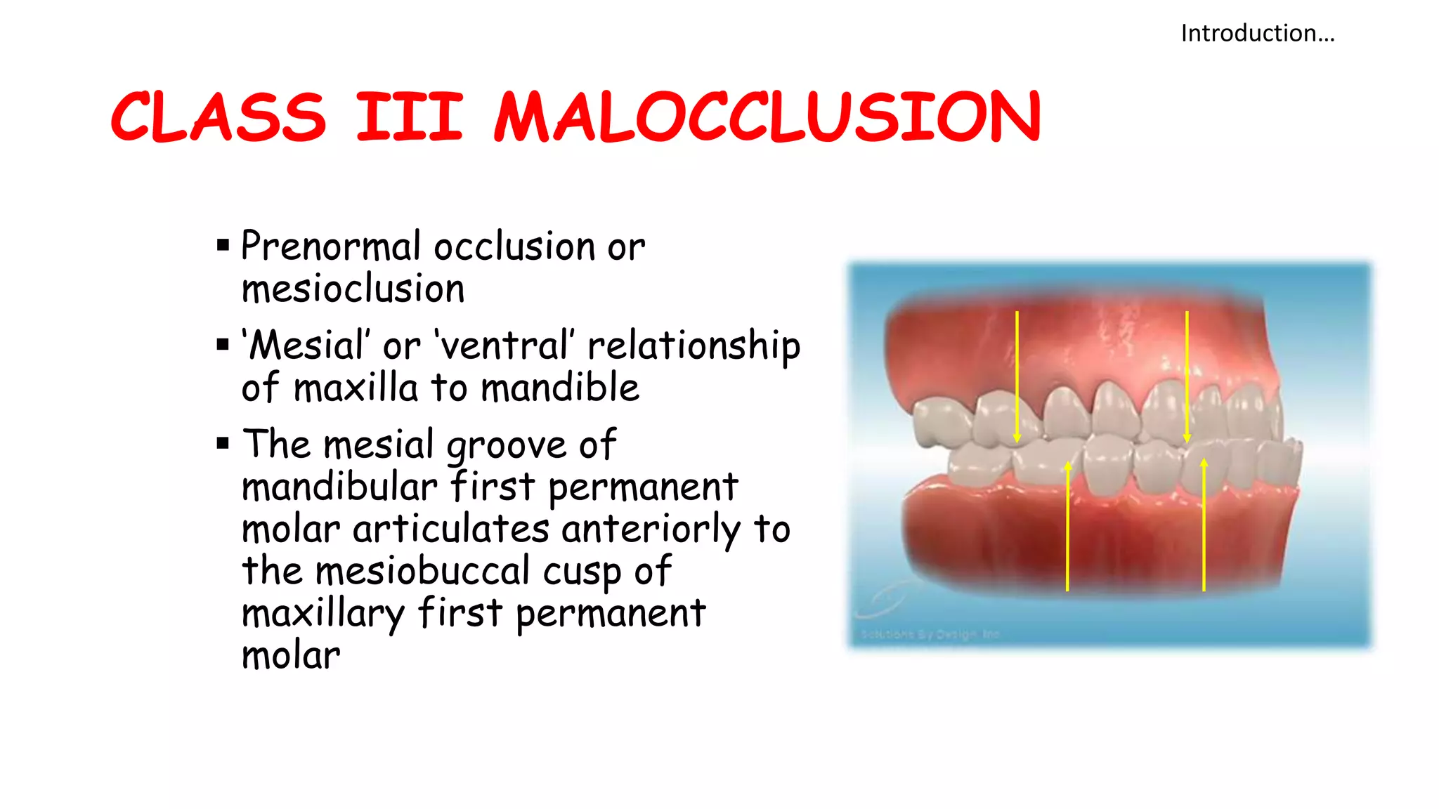 management of class ii and iii malocclusion | PPTX