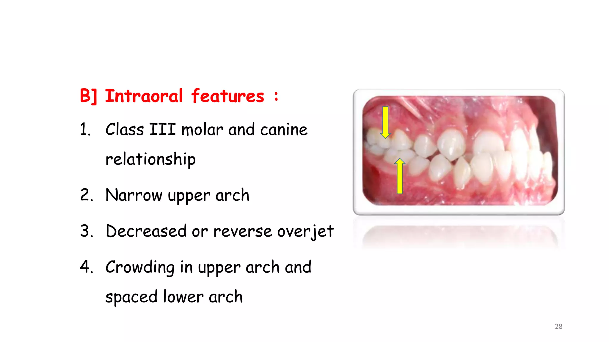 management of class ii and iii malocclusion | PPTX