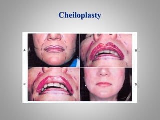 surgical interventions in orthodontics | PPTX