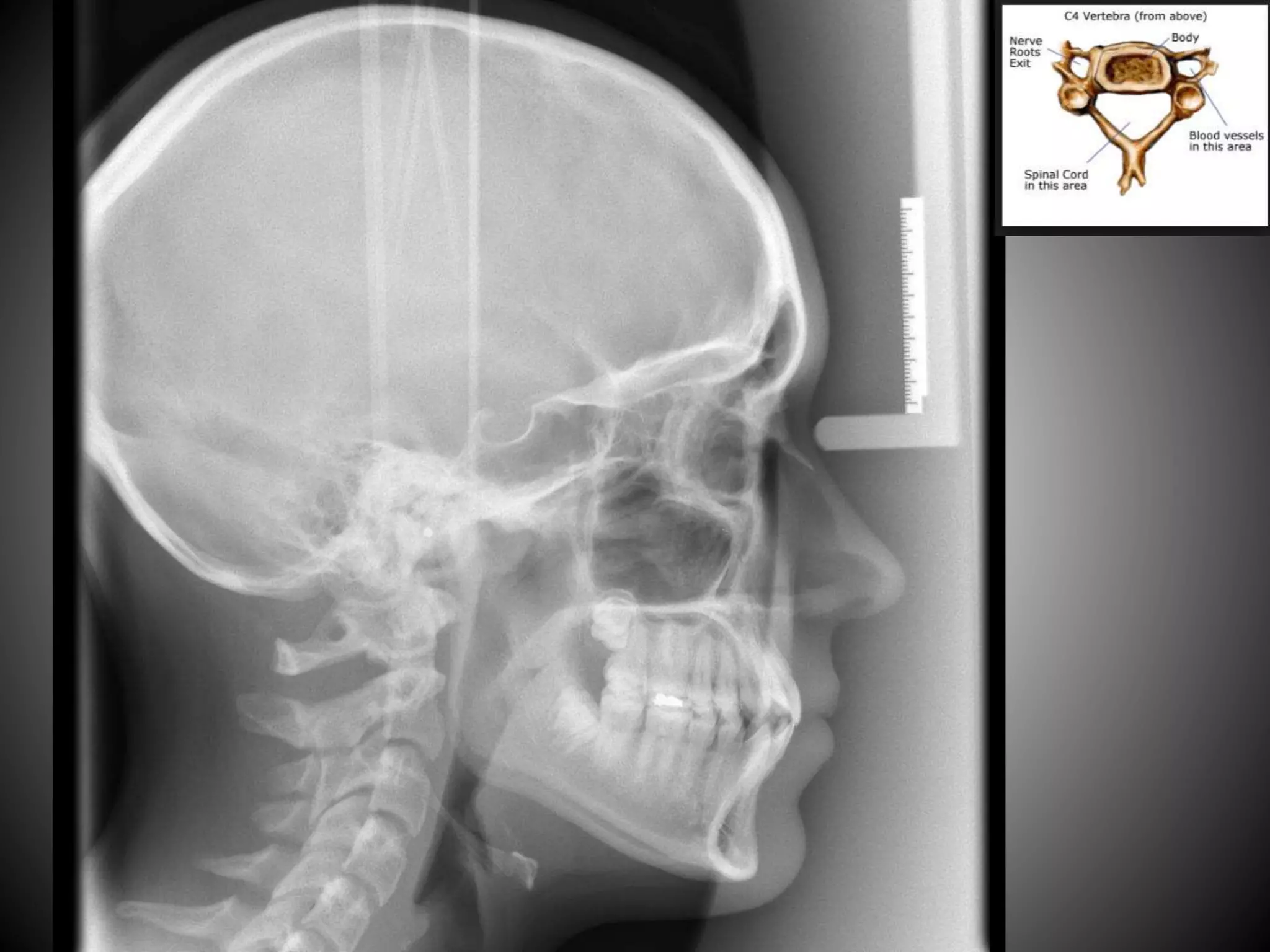 lateral cephalometry in orthodontics | PPTX