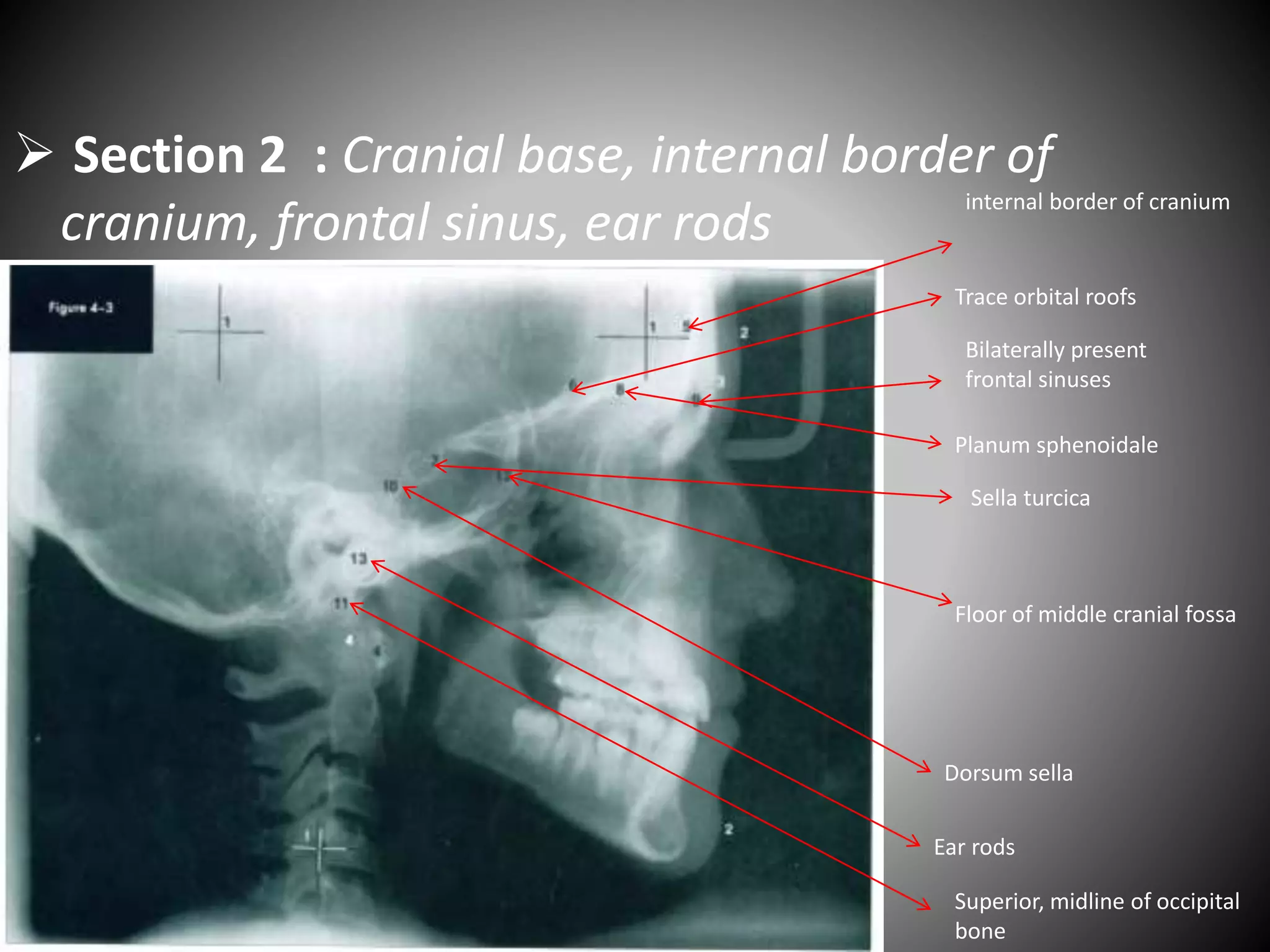 lateral cephalometry in orthodontics | PPTX