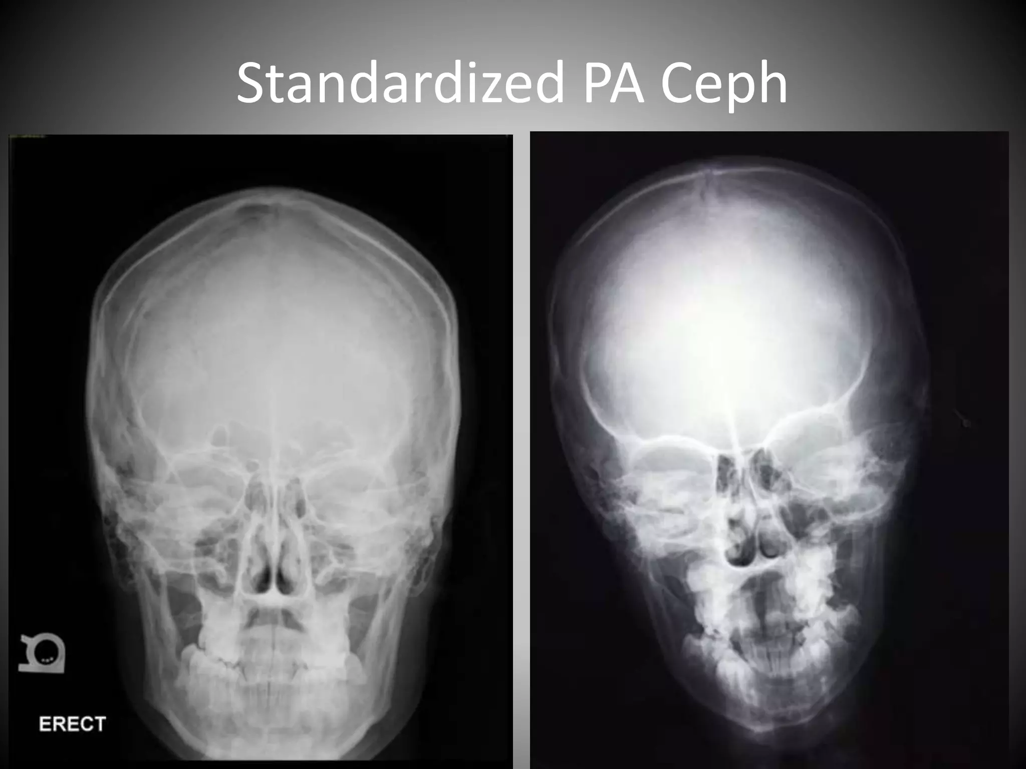 lateral cephalometry in orthodontics | PPTX | Dental Health | Diseases ...