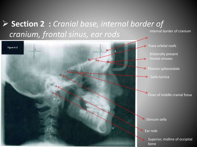 lateral cephalometry in orthodontics | PPTX | Dental Health | Diseases ...