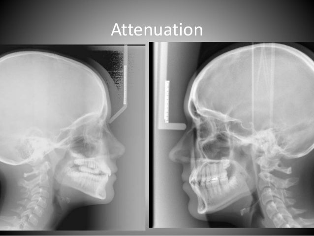 lateral cephalometry in orthodontics