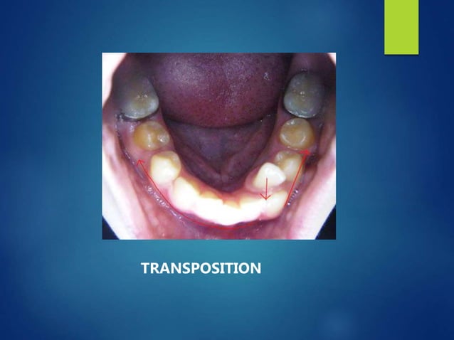 cast analysis | PPTX | Dental Health | Diseases and Conditions
