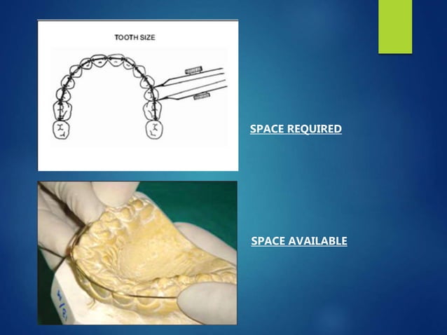 cast analysis | PPTX | Dental Health | Diseases and Conditions