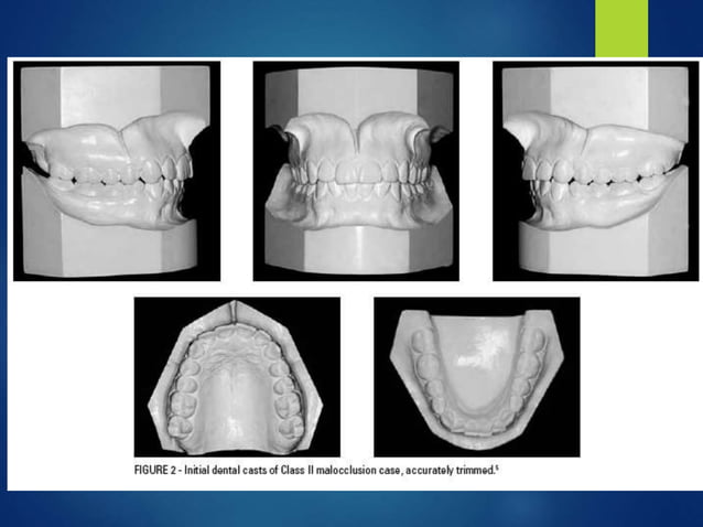 cast analysis | PPTX | Dental Health | Diseases and Conditions