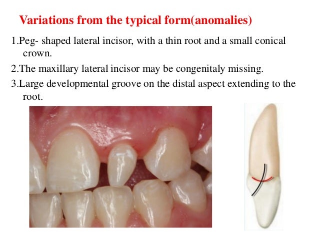 Lec.5. dental anatomy 2018-Permanent Maxillary lateral Incisors