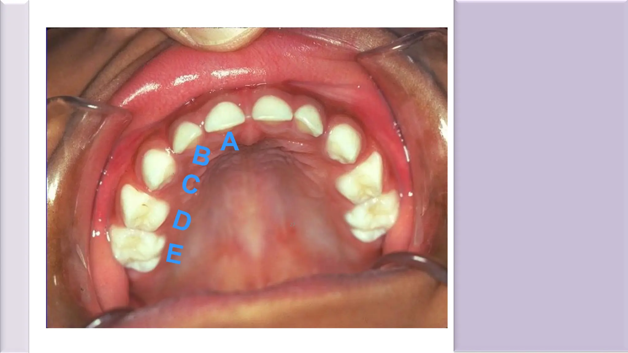 Lec.5 Morphology of the primary teeth(1).pdf