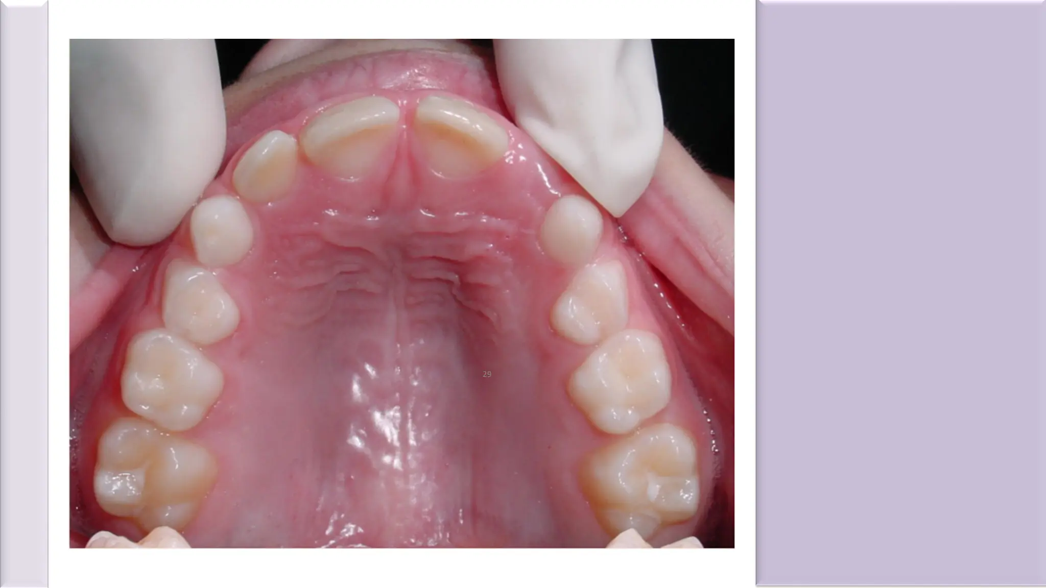 Lec.5 Morphology of the primary teeth(1).pdf