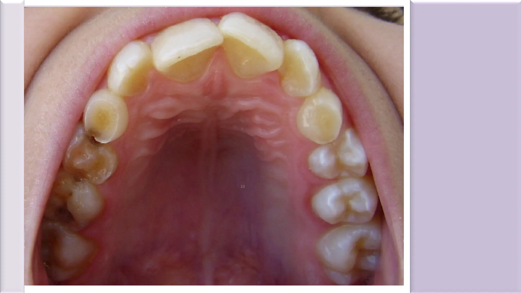 Lec.5 Morphology of the primary teeth(1).pdf