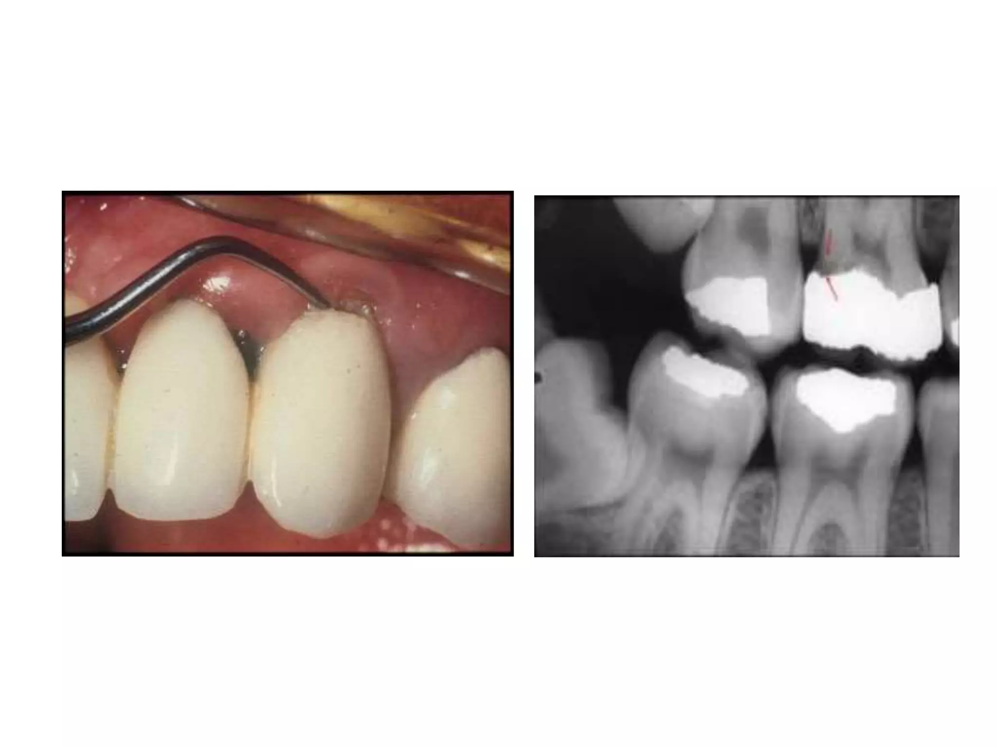 Dental Caries Classification Ppt