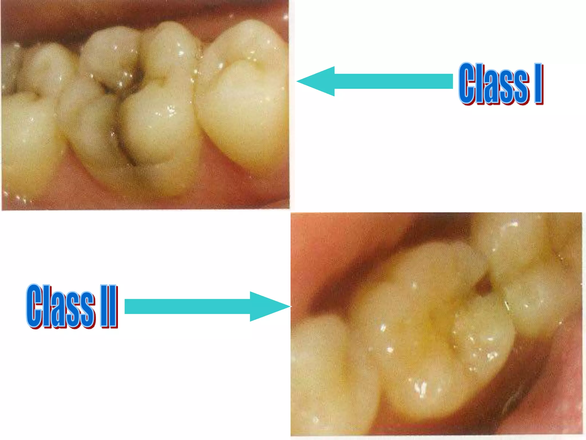 Dental caries classification.ppt