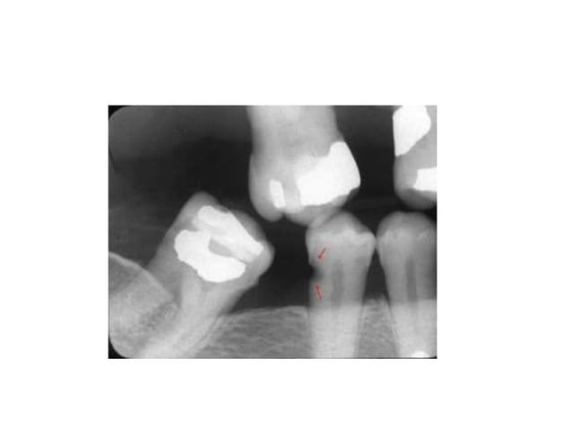 Dental Caries Classification Ppt