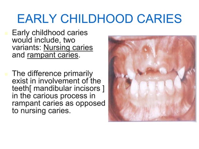 Dental caries classification.ppt