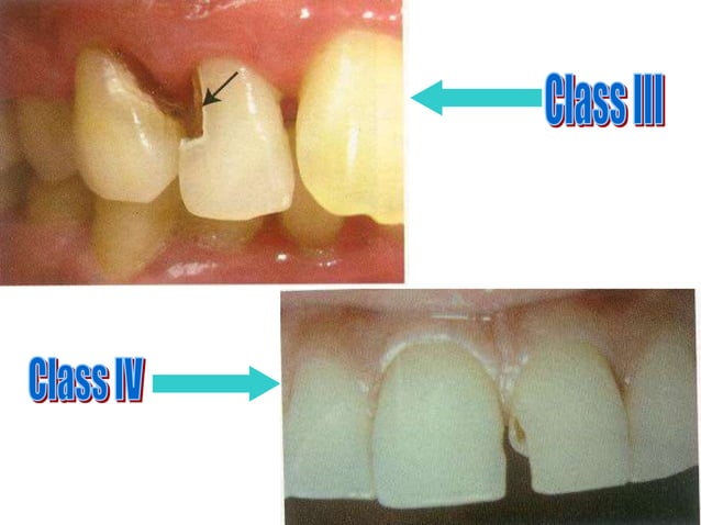 Dental caries classification.ppt