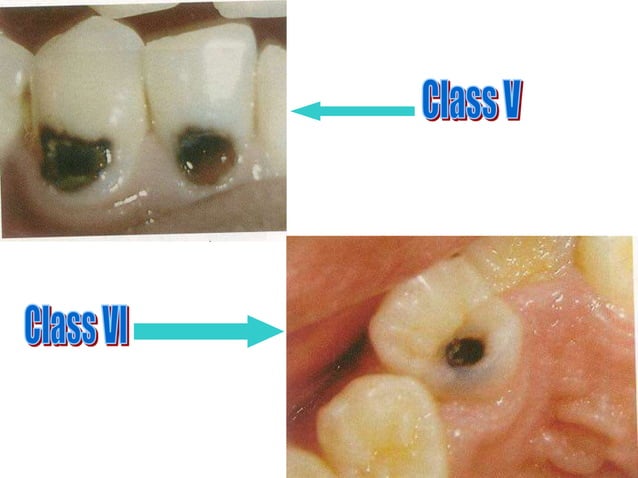 Dental caries classification.ppt