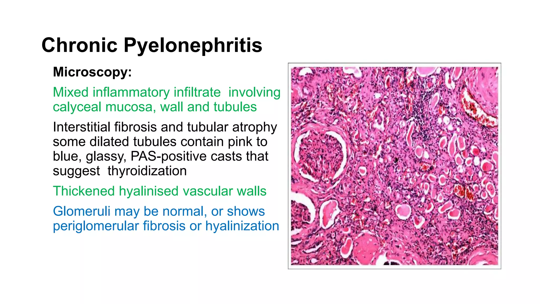 tubulointerstitial diseases- | PPTX
