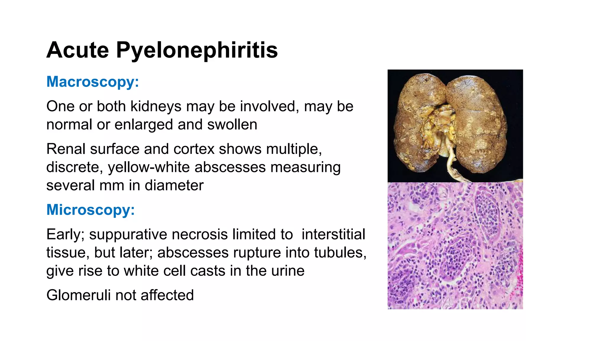 tubulointerstitial diseases- | PPTX