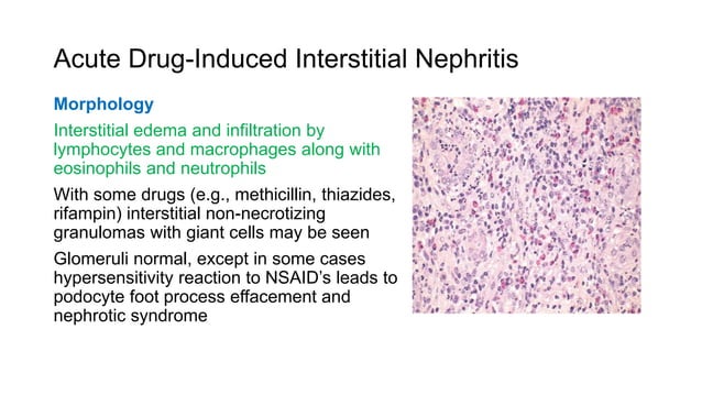 tubulointerstitial diseases- | PPTX | Digestive Disorders | Diseases ...
