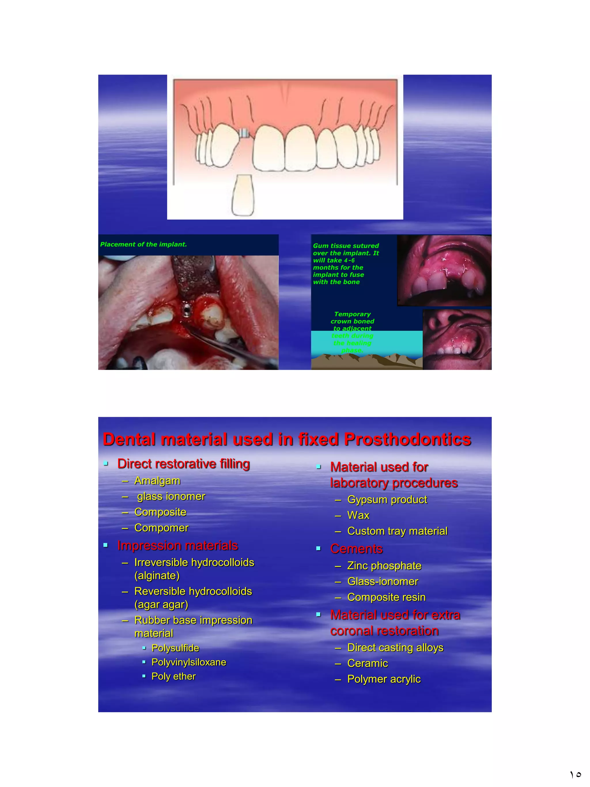 [Crown & Bridges] [terminology & classification] | PDF