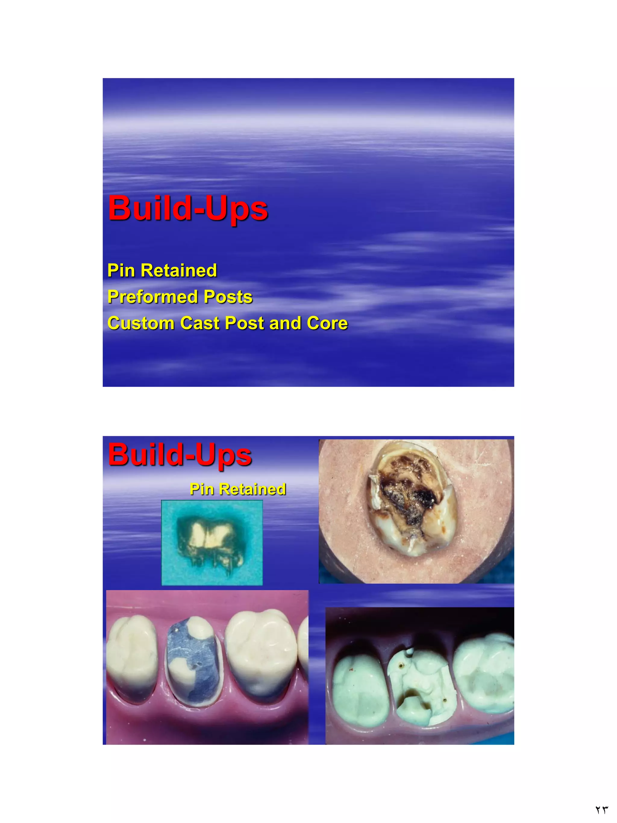 [Crown & Bridges] [terminology & classification] | PDF