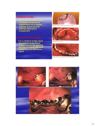 [Crown & Bridges] [terminology & classification] | PDF