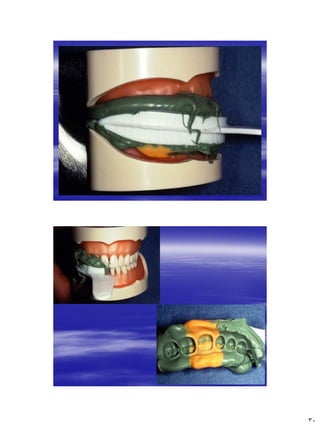 [Crown & Bridges] [terminology & classification] | PDF