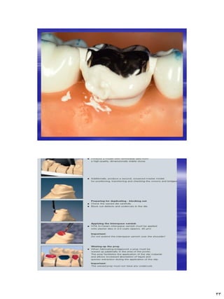[Crown & Bridges] [terminology & classification] | PDF