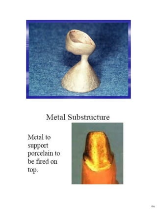 [Crown & Bridges] [terminology & classification] | PDF