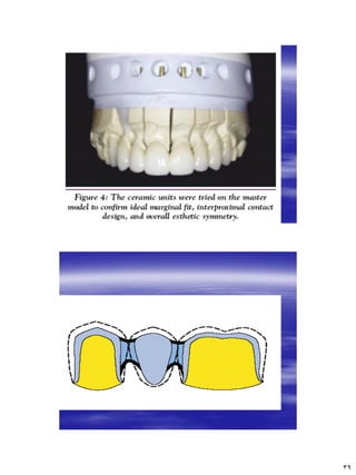 [Crown & Bridges] [terminology & classification] | PDF
