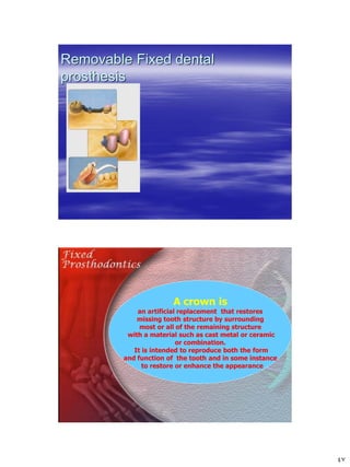 [Crown & Bridges] [terminology & classification] | PDF