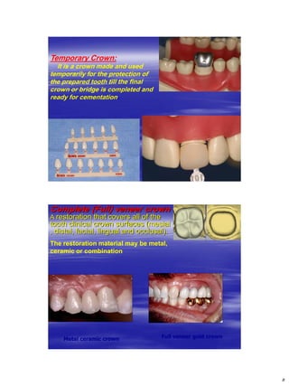 [Crown & Bridges] [terminology & classification] | PDF