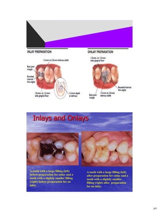 [Crown & Bridges] [terminology & classification] | PDF