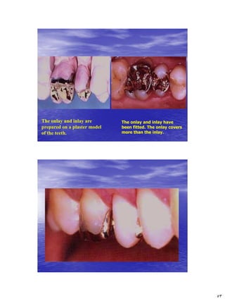 [Crown & Bridges] [terminology & classification] | PDF