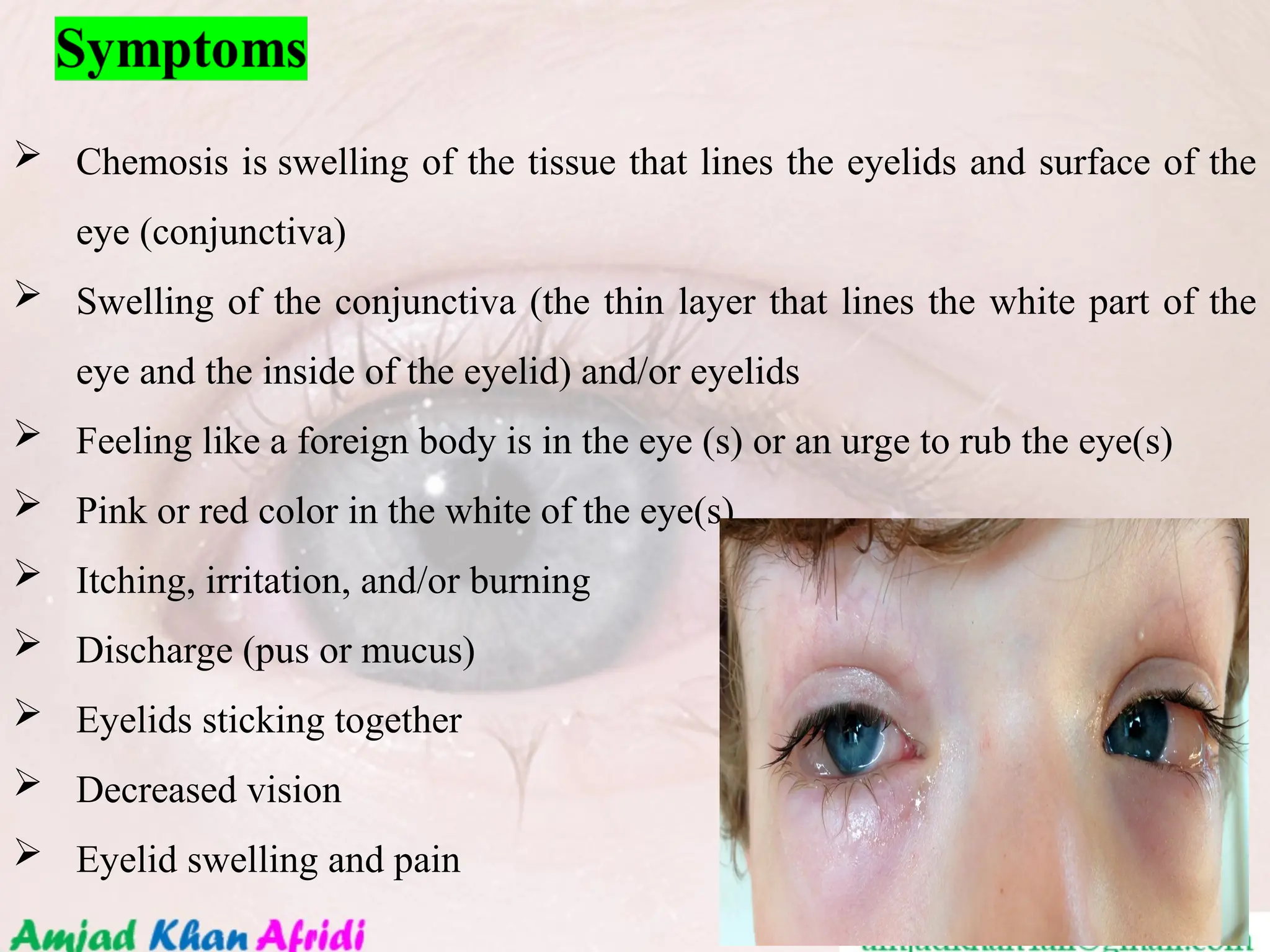 Eyes Infection (conjunctivitis) . | PPT