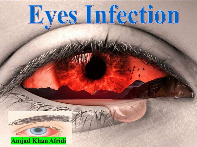 Eyes Infection (conjunctivitis) . | PPT | Eye and Vision Conditions ...