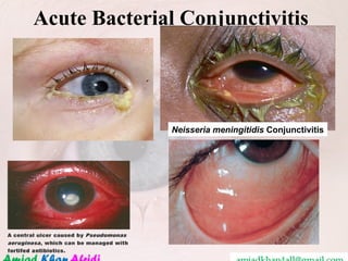 Eyes Infection (conjunctivitis) . | PPT