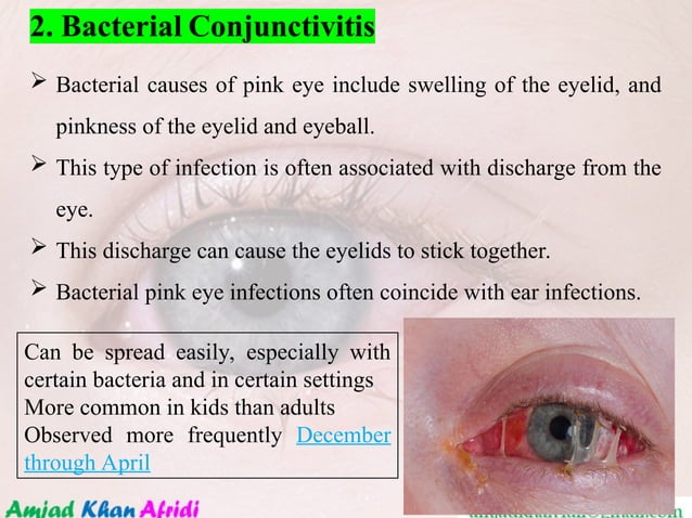 Eyes Infection (conjunctivitis) . | PPT | Eye and Vision Conditions | Diseases and Conditions