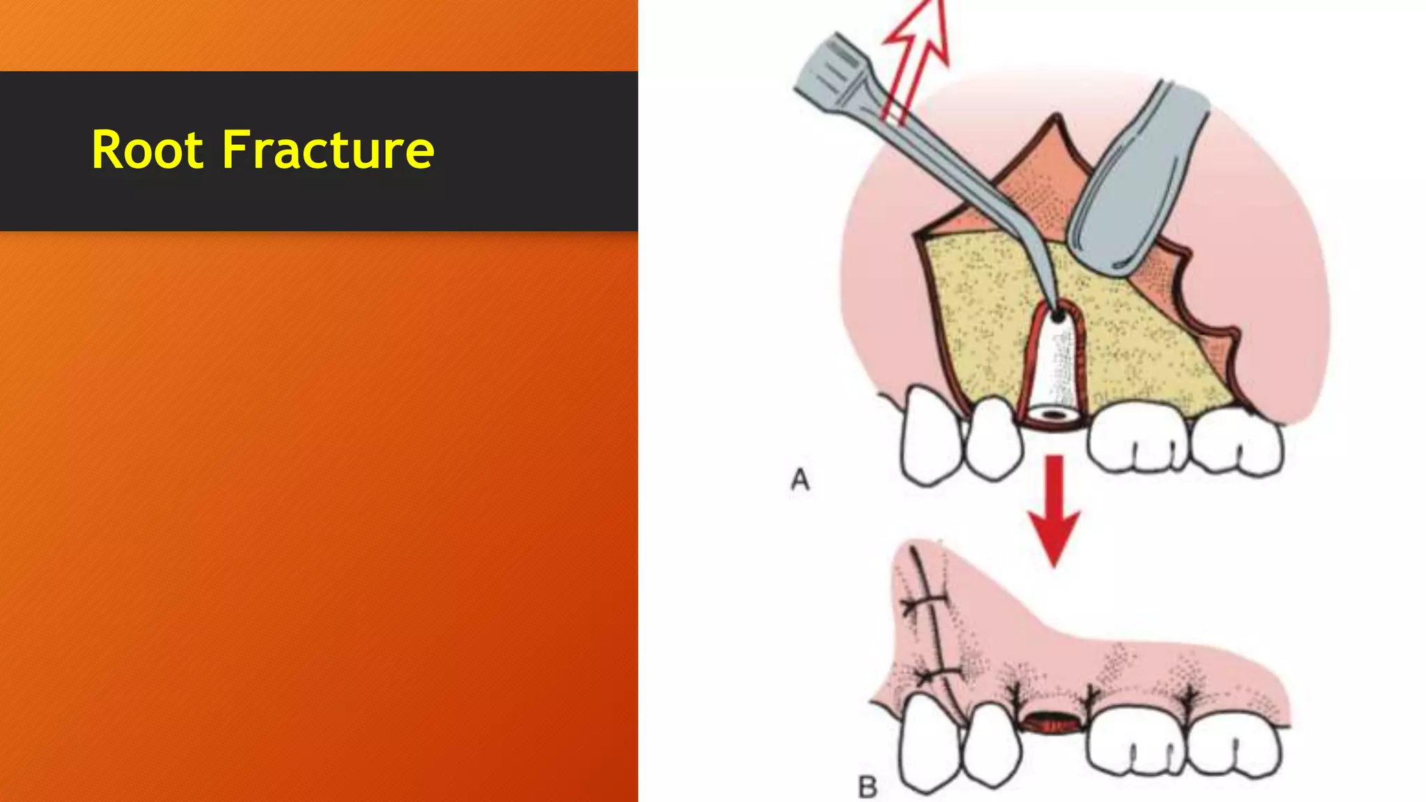 complications of tooth extraction | PPTX