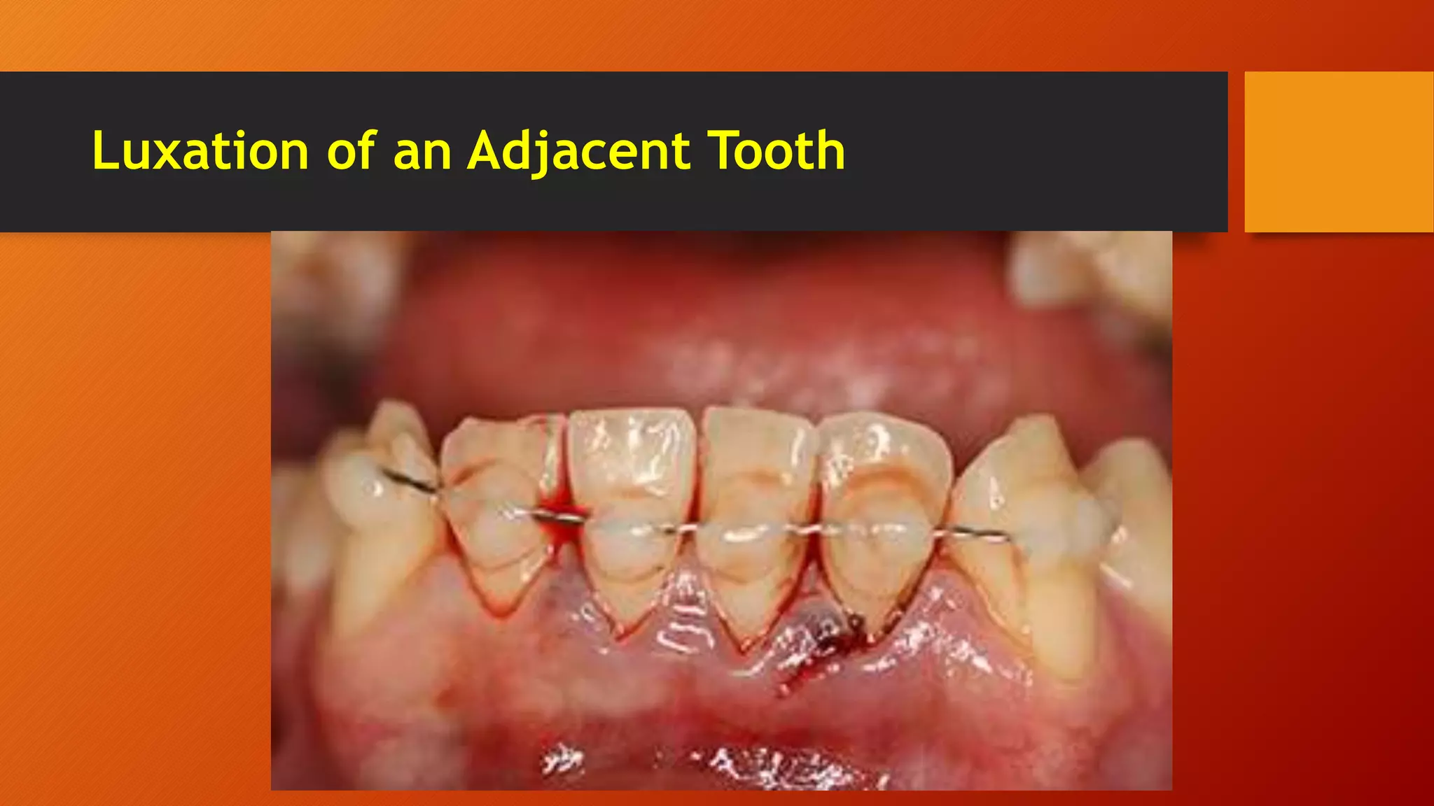 complications of tooth extraction | PPTX