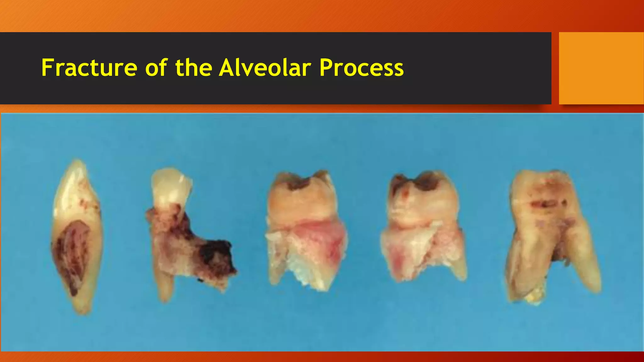 complications of tooth extraction | PPTX