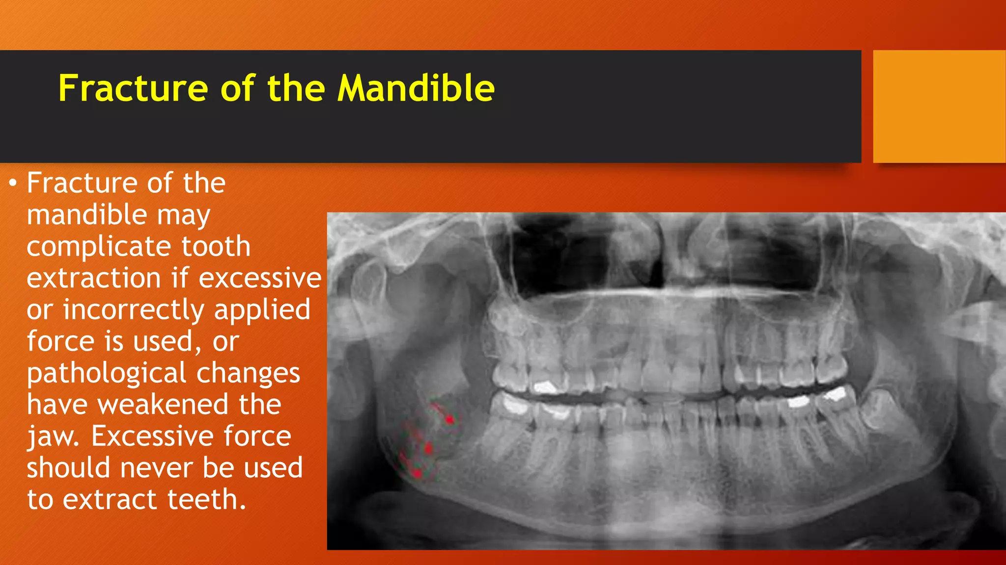 complications of tooth extraction | PPTX