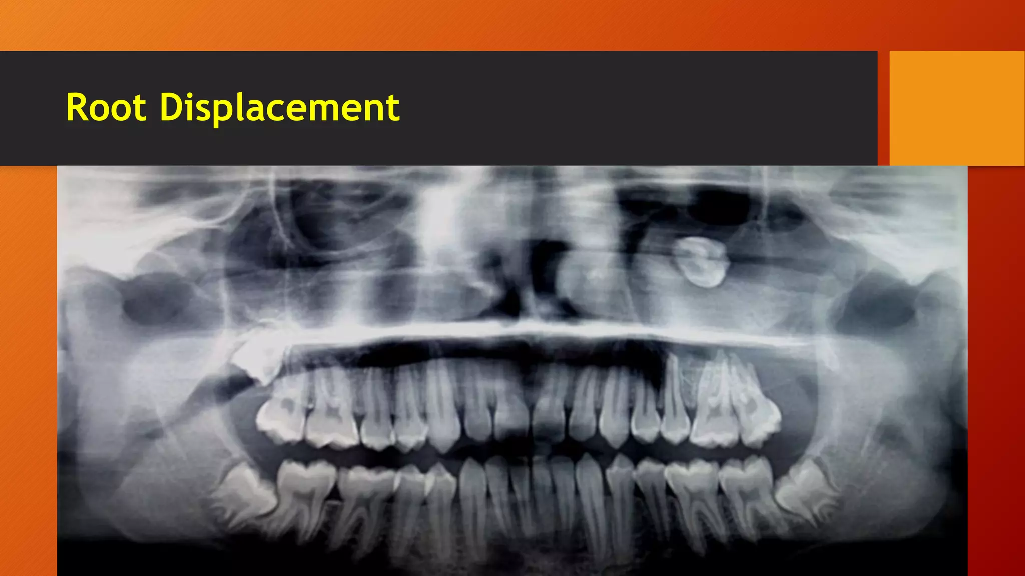 complications of tooth extraction | PPTX