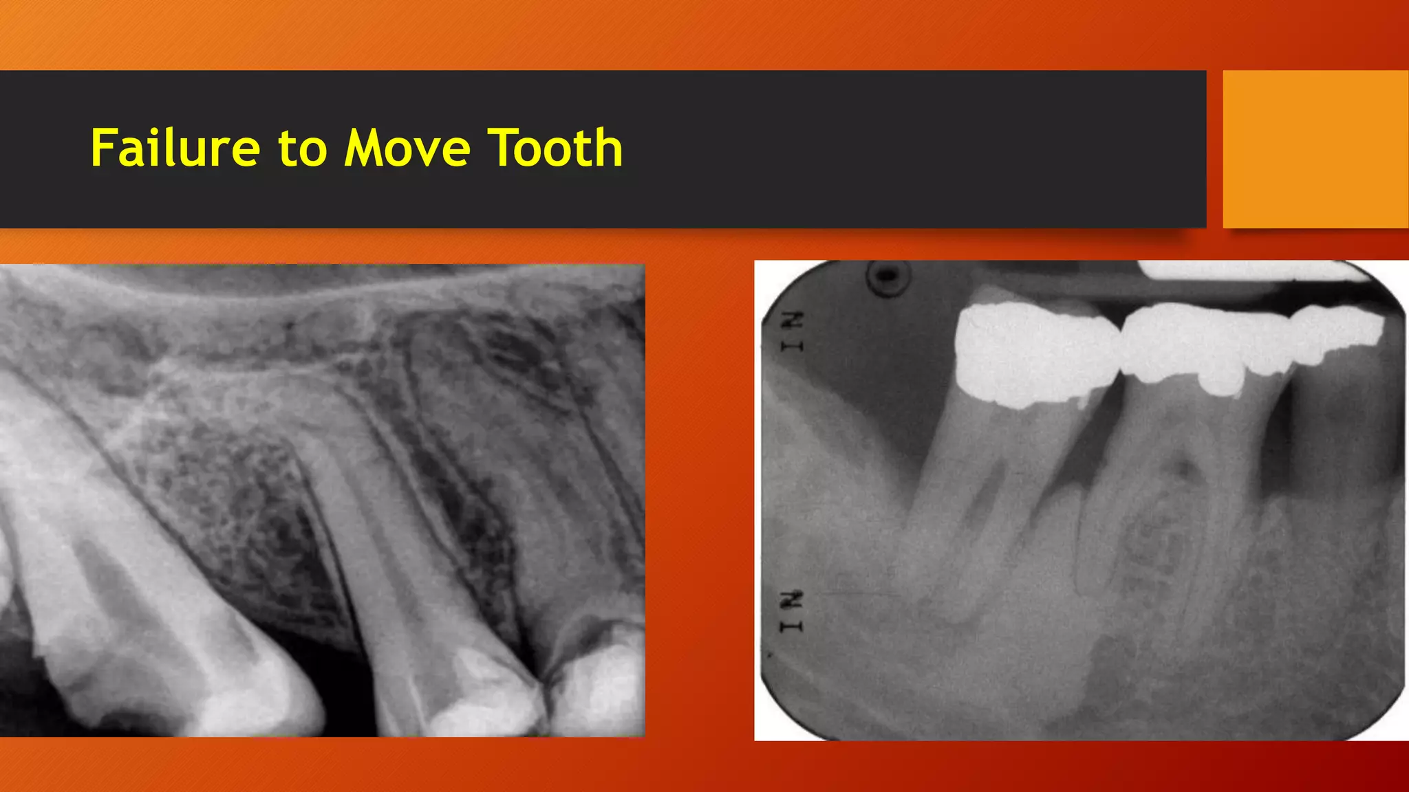 complications of tooth extraction | PPTX