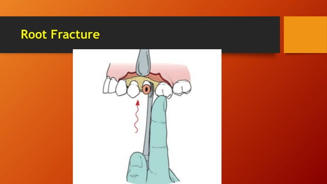 complications of tooth extraction | PPTX