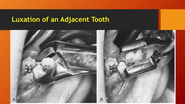 complications of tooth extraction | PPTX