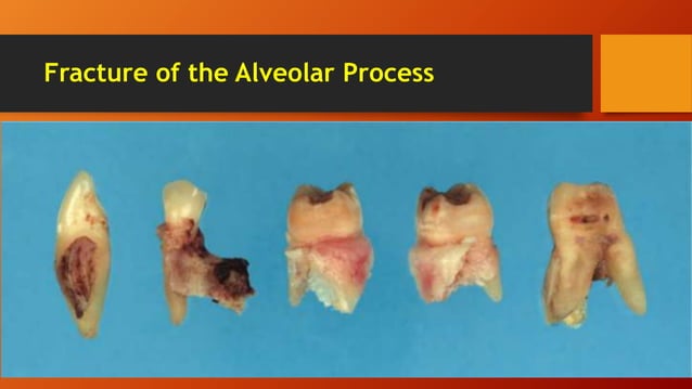 complications of tooth extraction | PPTX